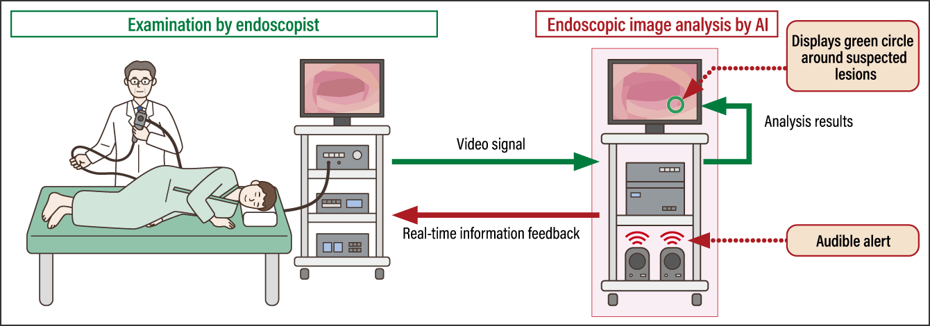 Can AI-based Computer-Aided Detection (CADe) system in endoscopy reduce ...